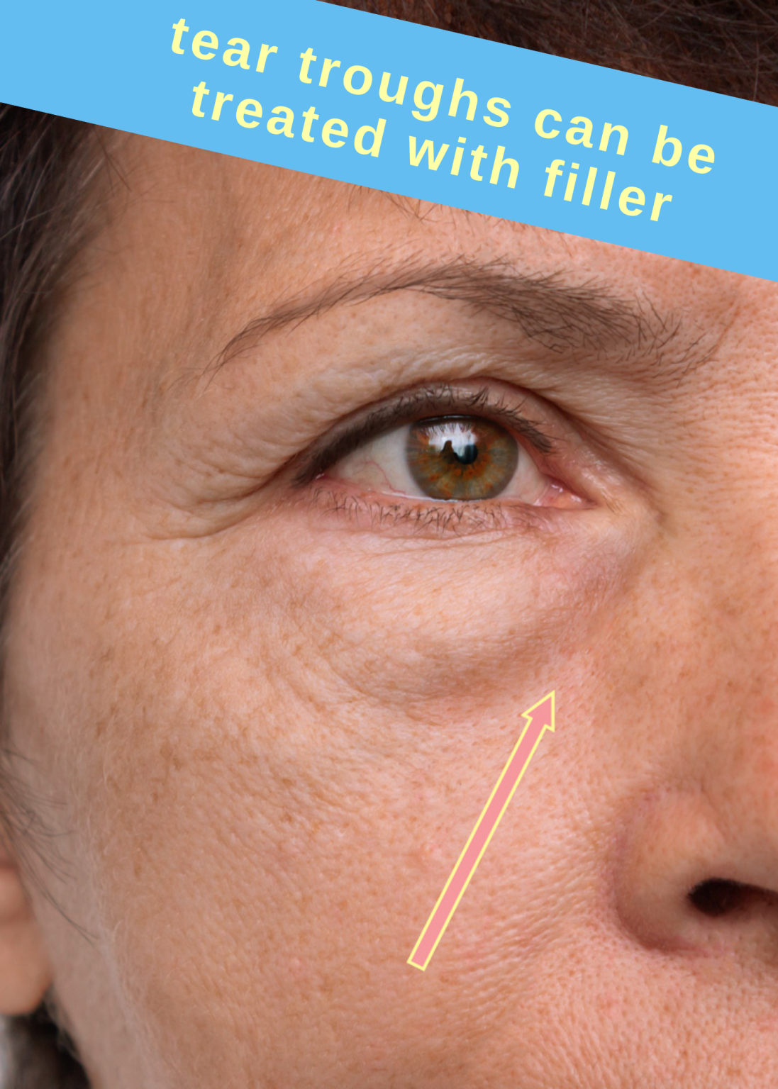 What Are Tear Troughs and Do Mine Need to be Filled? | Jeffrey Kenkel, MD