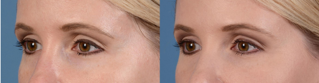 What Are Tear Troughs and Do Mine Need to be Filled? | Jeffrey Kenkel, MD