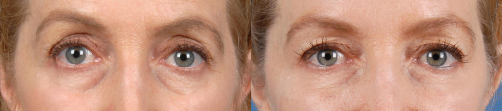 What Are Tear Troughs and Do Mine Need to be Filled? | Jeffrey Kenkel, MD