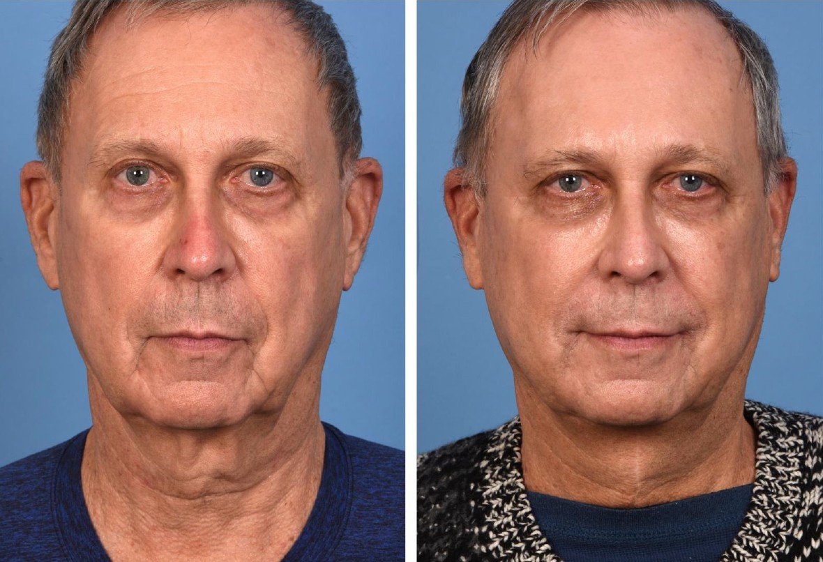 How Are Male Facelifts Different? Exploring Facial Rejuvenation Options ...