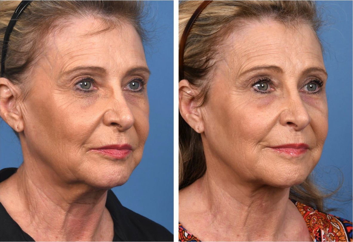 How Are Male Facelifts Different? Exploring Facial Rejuvenation Options ...